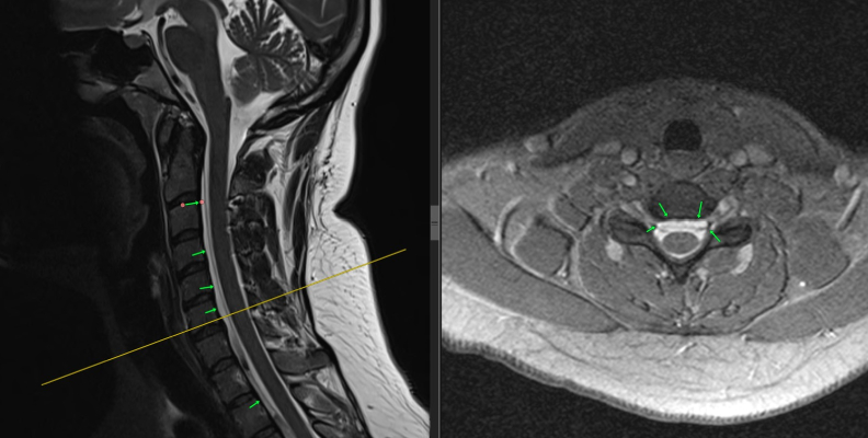 Concussion Misdiagnosis Example - Portland Whiplash Spine