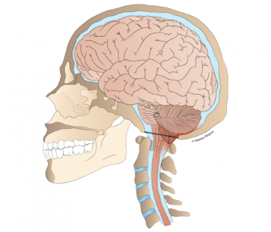 Concussion Misdiagnosis Example - Portland Whiplash Spine